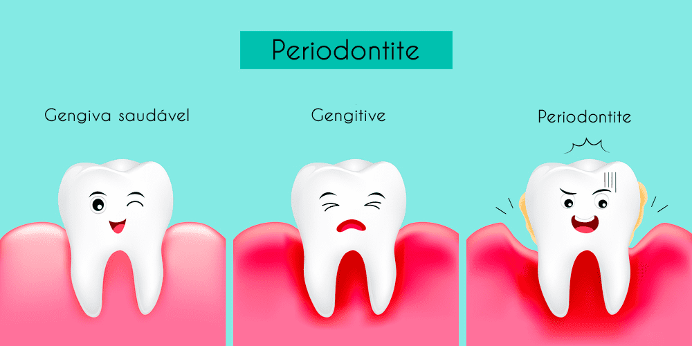 Periodontite: O Que É, Causas, Sintomas e Tratamentos - Stelle Odontologia